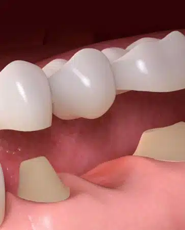 Fixed Dental Bridges Danville | Dentures Mt Vernon | Dental Bridges 43014