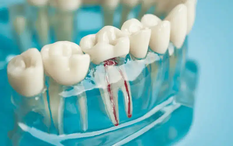 Does Root Canal Treatment Hurt? Common Myths and Facts - Danville ...