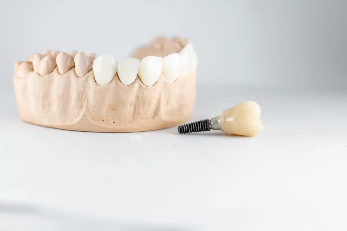Which Dental Implant Type Is Right For You 3 Options Explained