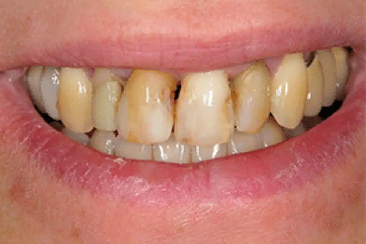 How Dangerous Is a Spreading Tooth Infection?